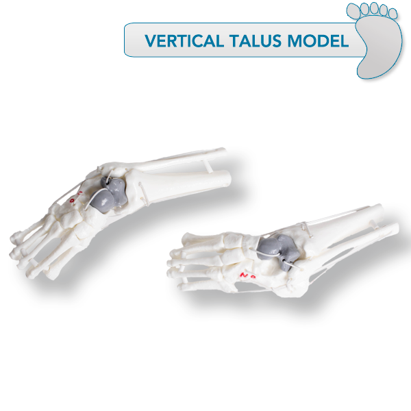 Vertical Talus Model, Set – Massons Healthcare